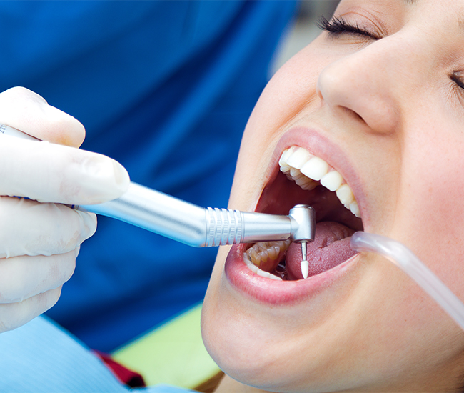 Dental Fillings in Etobicoke | Roha Dental